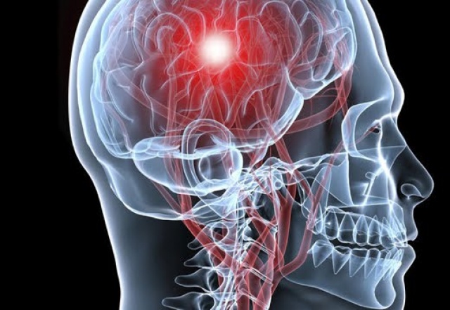 Dia Mundial do AVC: SP reforça alerta para prevenção e reconhecimento ...